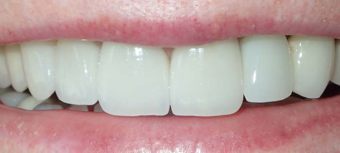 All Ceramic Dental Crowns - Fairfax Cosmetic Dentistry